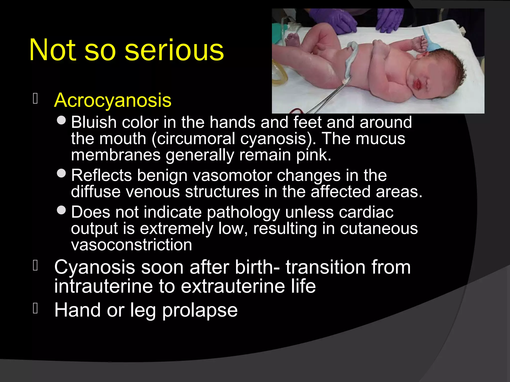 Approach to a Neonate with Cyanosis | PPT
