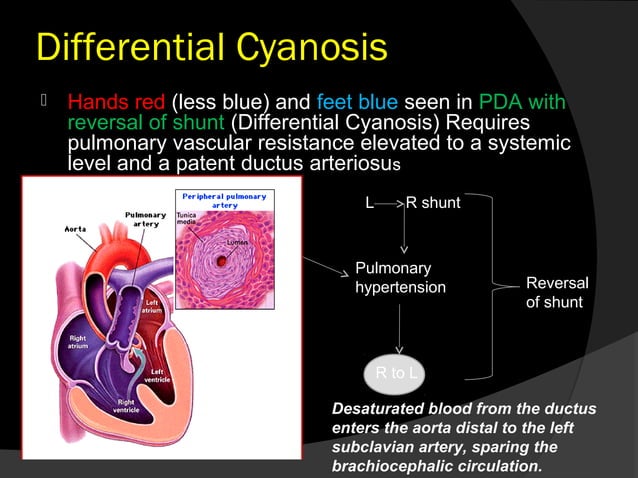 Approach to a Neonate with Cyanosis | PPT