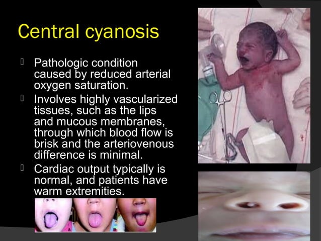 Approach to a Neonate with Cyanosis | PPT