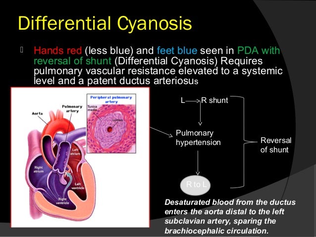 Approach to a Neonate with Cyanosis