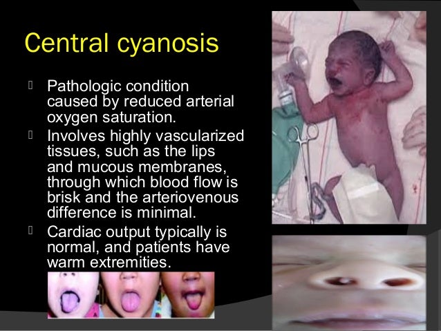 Approach to a Neonate with Cyanosis
