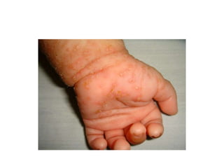 Neonatal dermatoses | PPTX