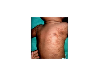 Neonatal dermatoses | PPTX