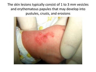 Neonatal dermatoses | PPTX