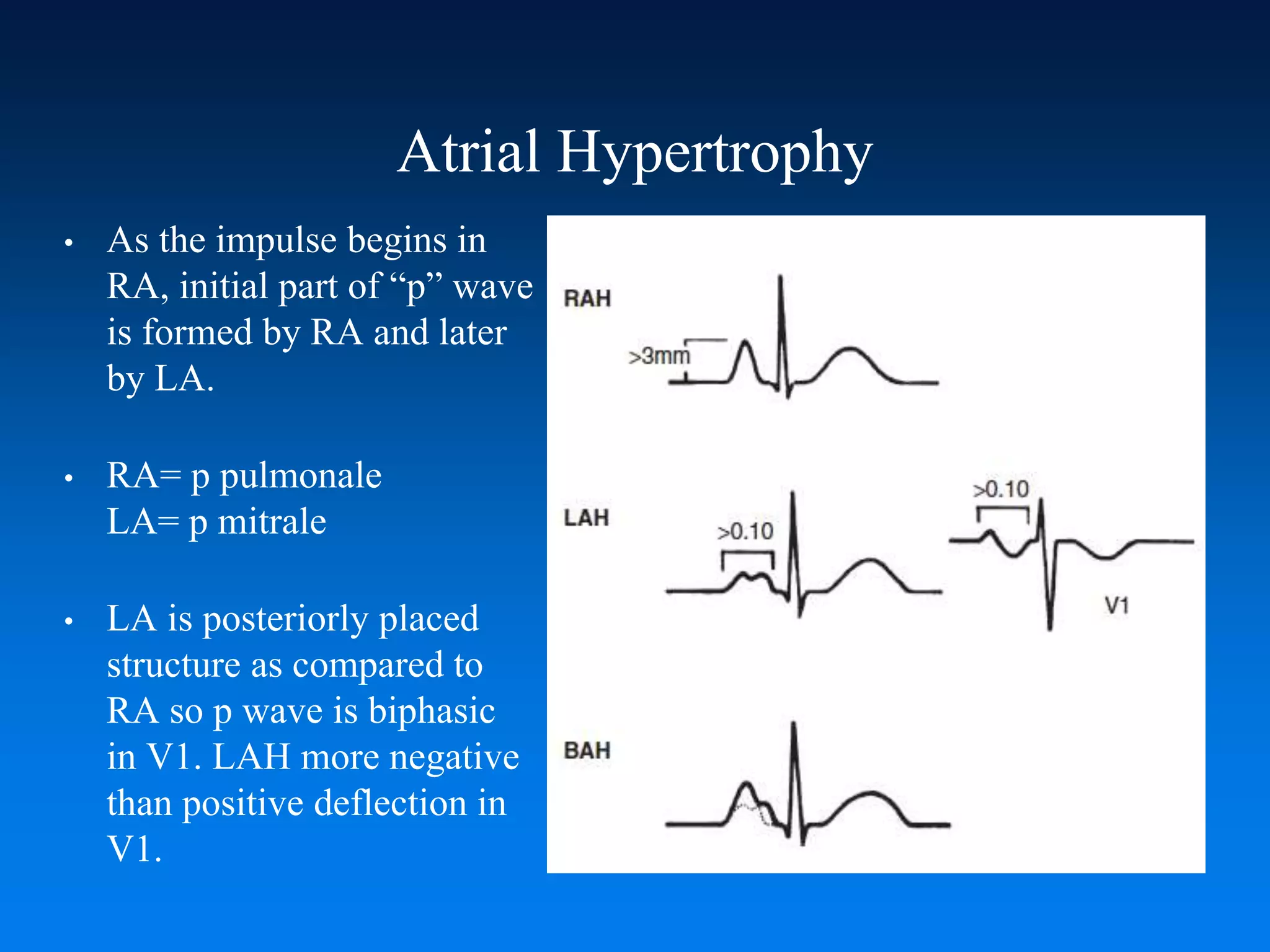 Neonatal ecg part2 | PPTX