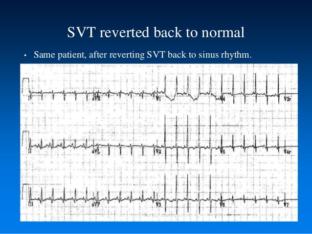 Neonatal ecg part2