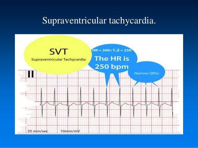 Neonatal ecg part2