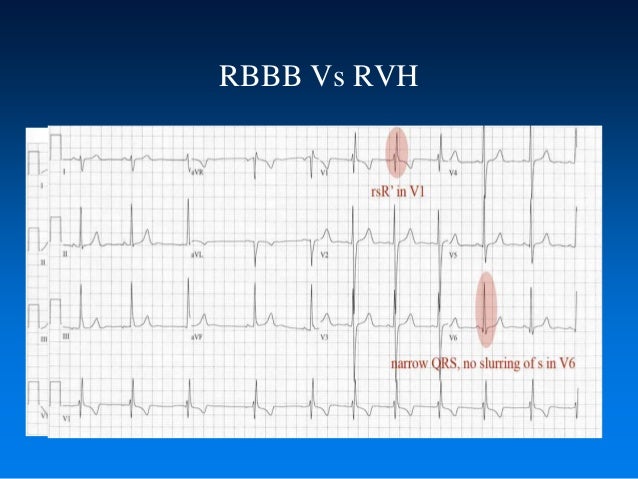 Neonatal ecg part2
