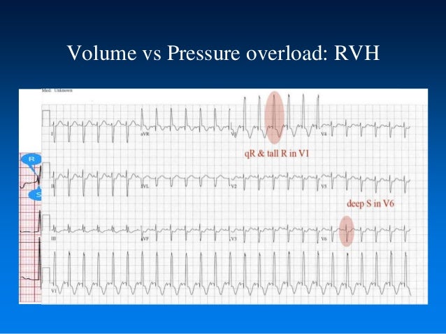 Neonatal ecg part2