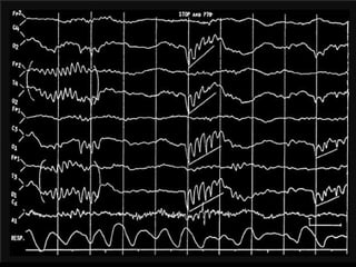 Neonatal EEG Patterns | PPT