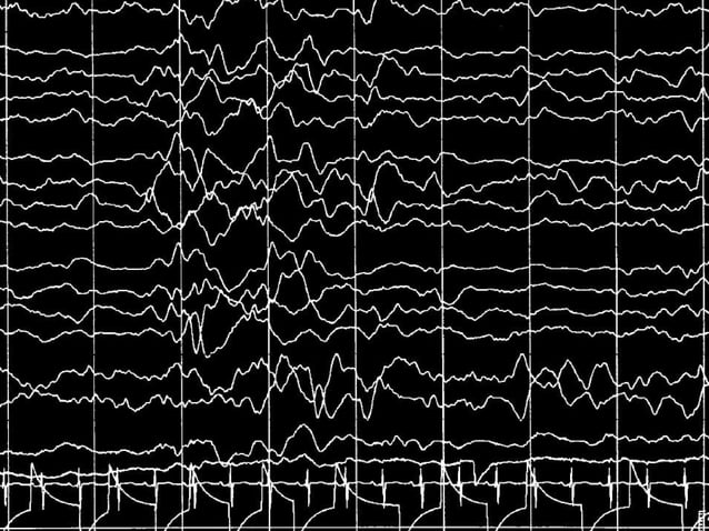 Neonatal EEG Patterns | PPT