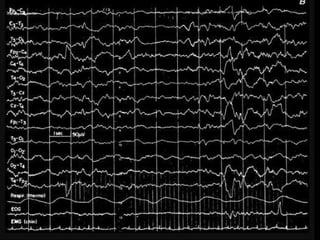 Neonatal EEG Patterns | PPT