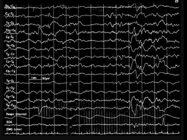 Neonatal EEG Patterns | PPT