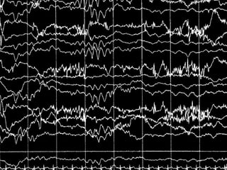 Neonatal EEG Patterns | PPT
