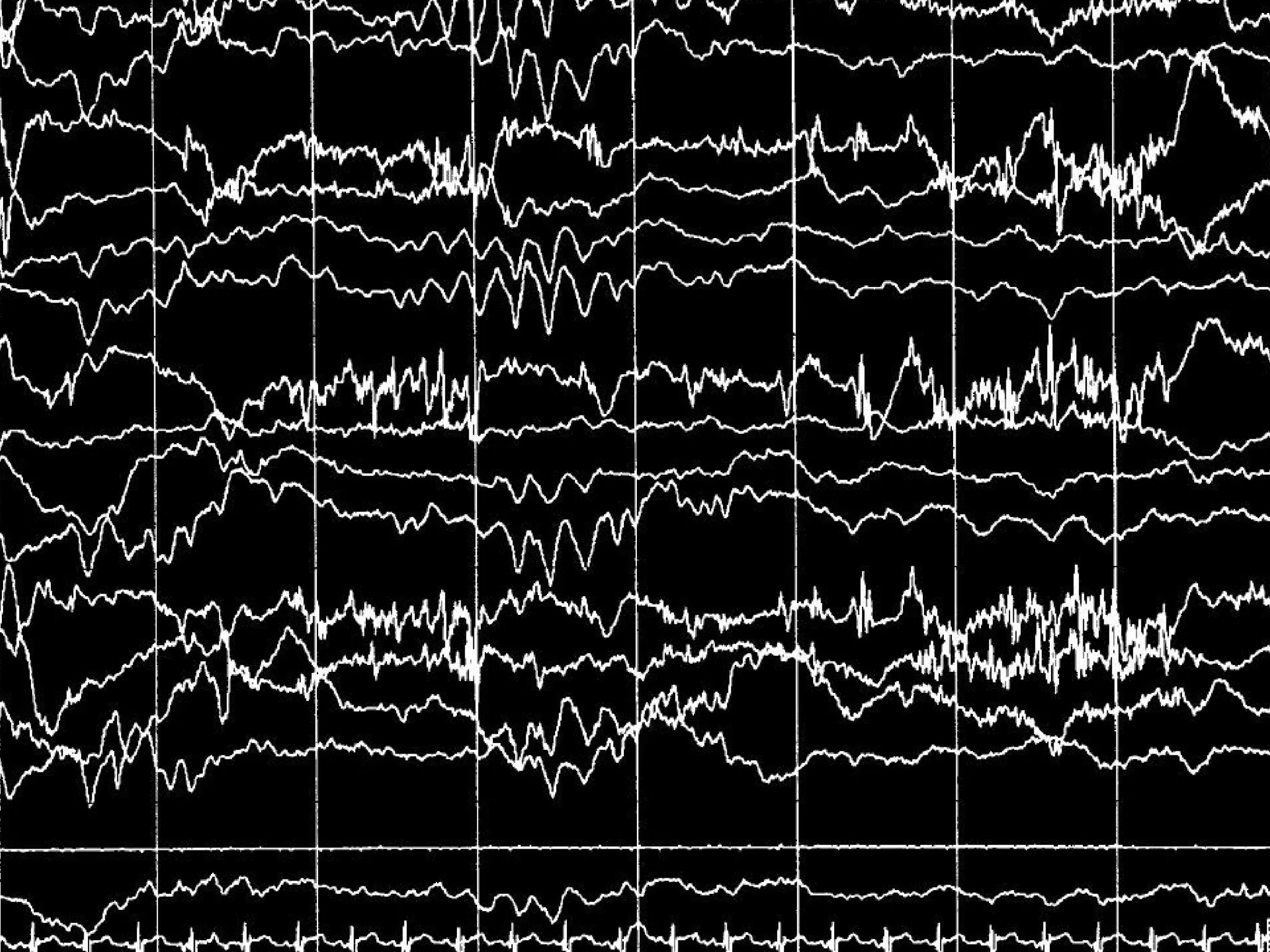 EEG in Neonates - Normal Variants and Pathological Traces | PPT