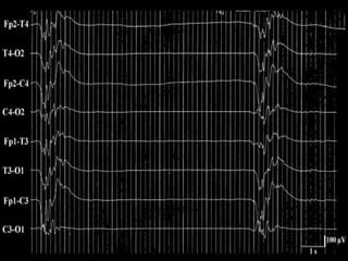 EEG in Neonates - Normal Variants and Pathological Traces | PPT