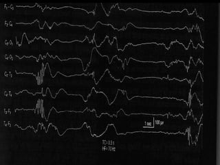 EEG in Neonates - Normal Variants and Pathological Traces | PPT