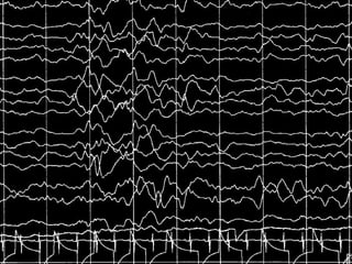 EEG in Neonates - Normal Variants and Pathological Traces | PPT