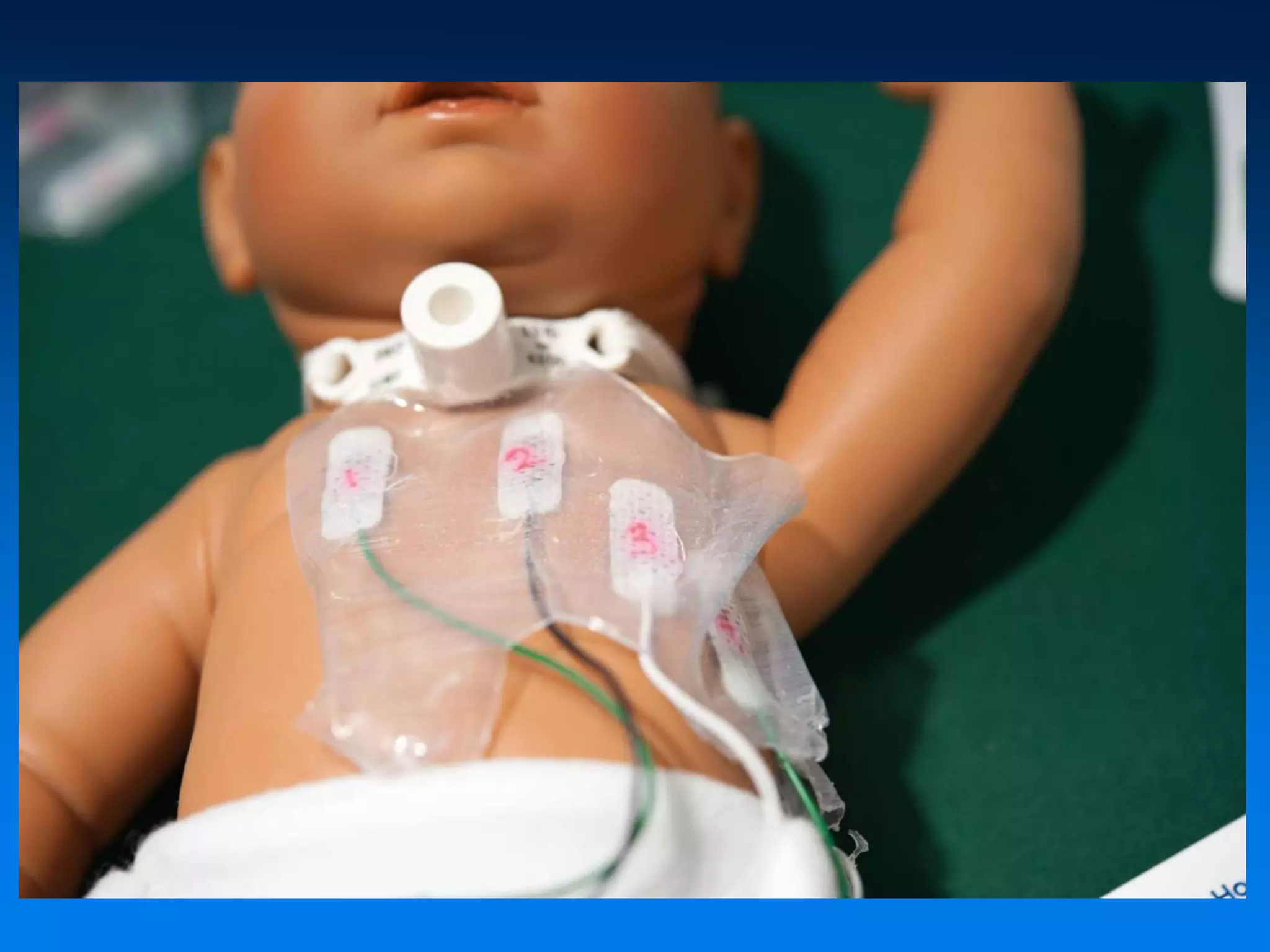 Neonatal ekg | PPT