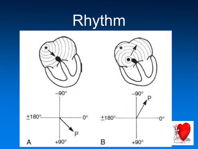 Neonatal ekg | PPT