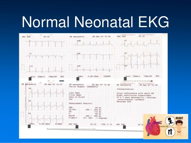 Neonatal ekg