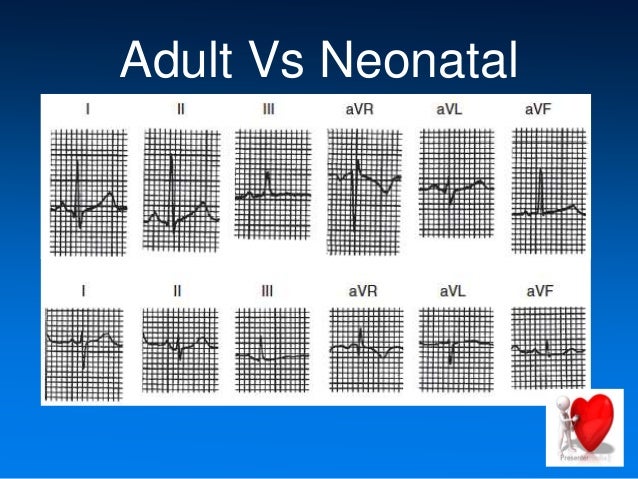 Neonatal ekg