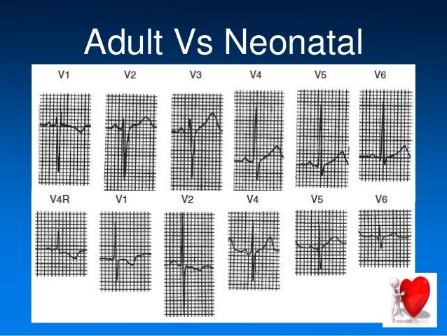 Neonatal ekg