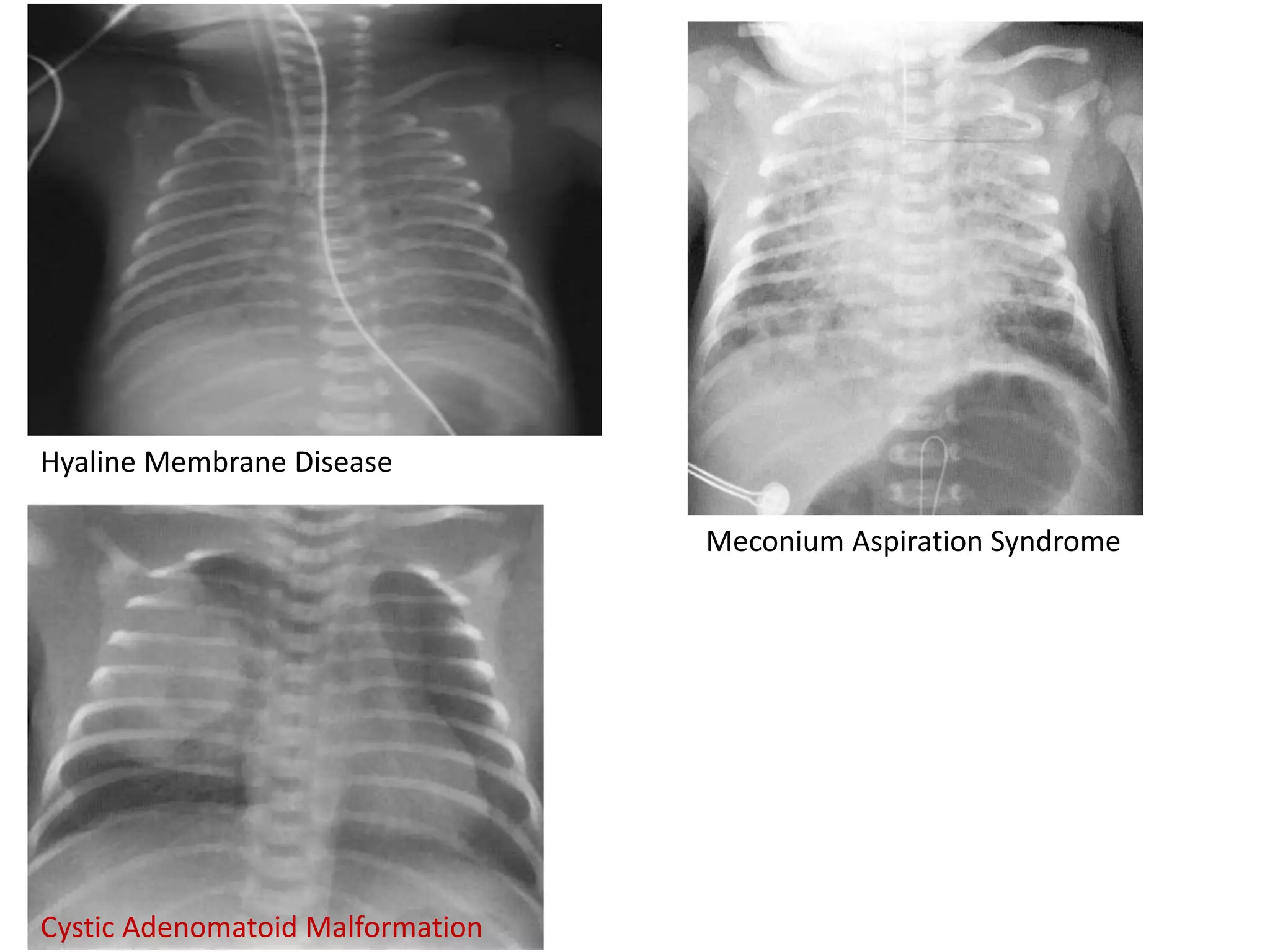 Neonatal emergencies | PPTX