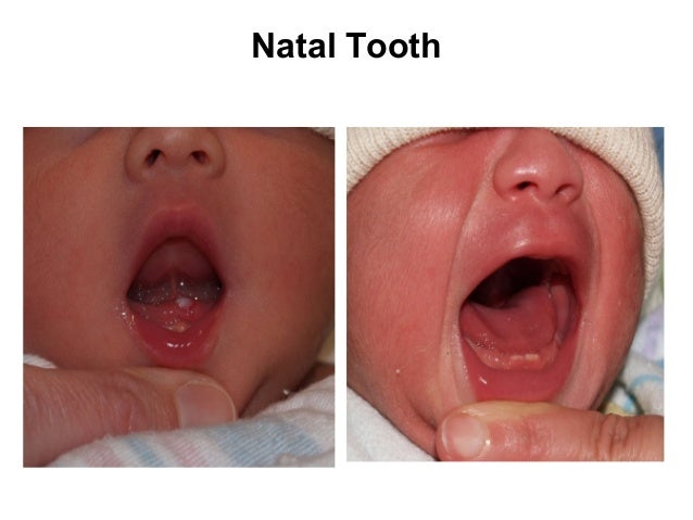 Neonatal examination
