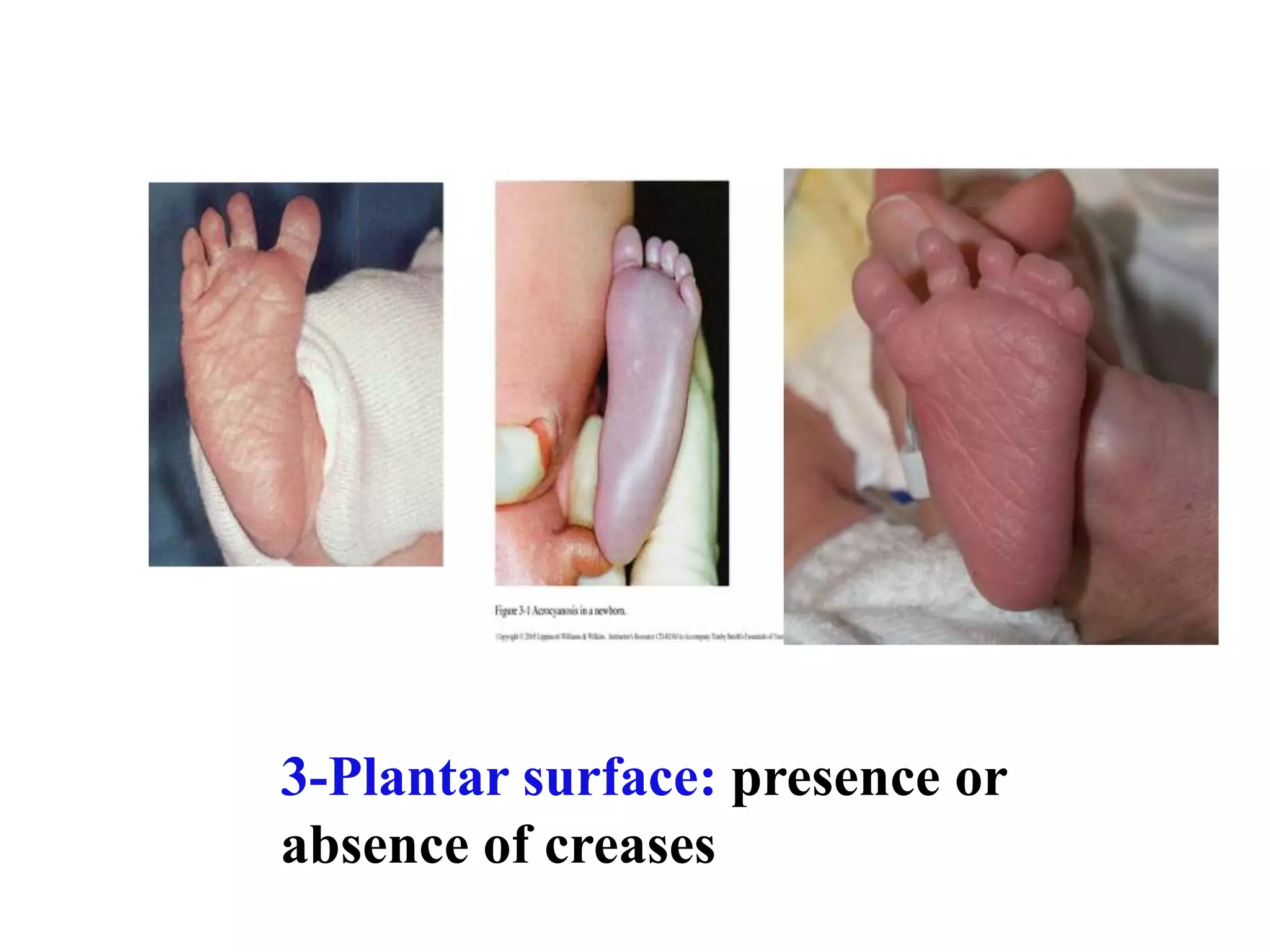 Neonatal Gestational Age Assessment.ppt