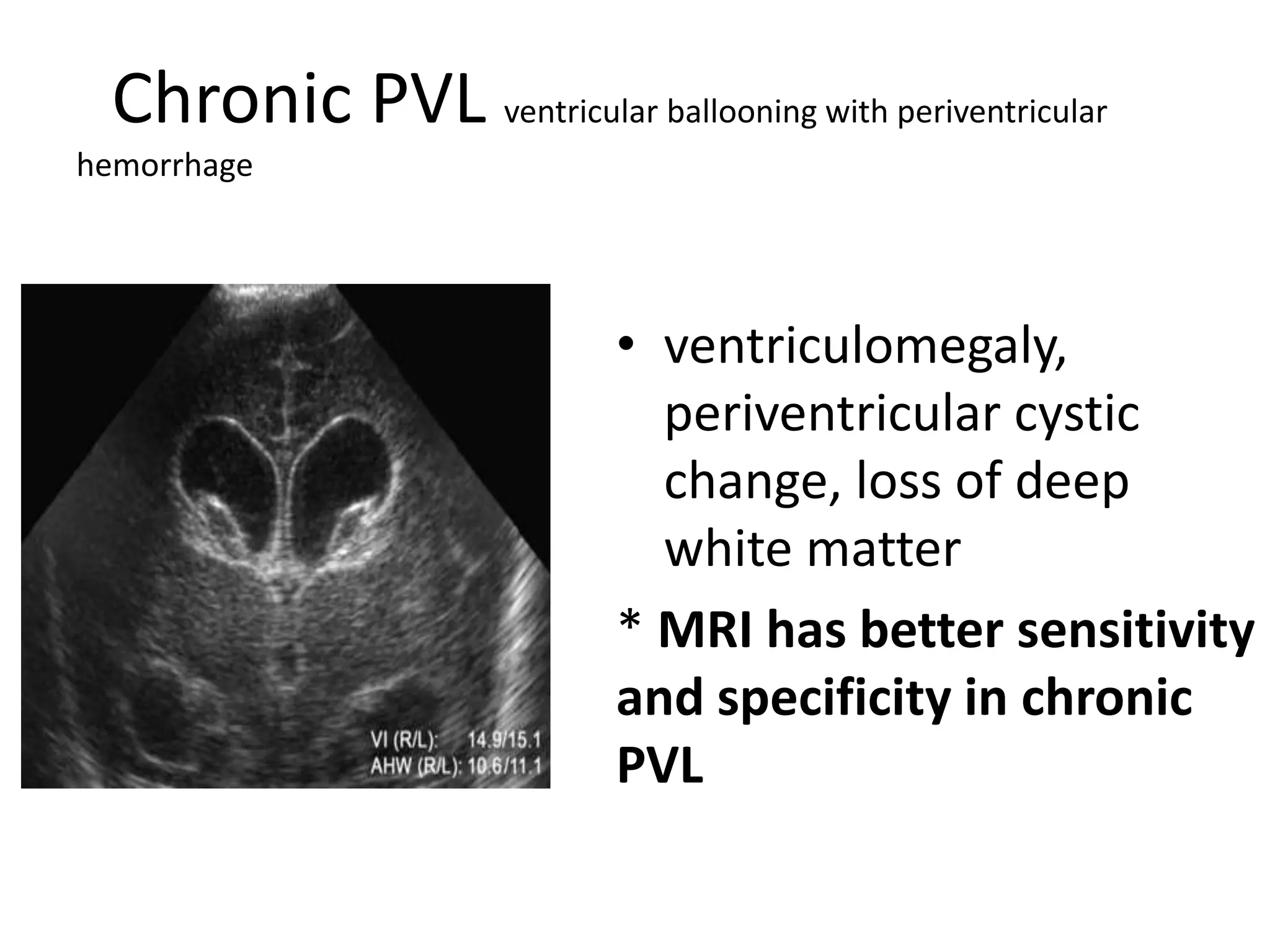 Neonatal head usg | PPT