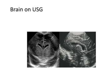 Neonatal head usg | PPT