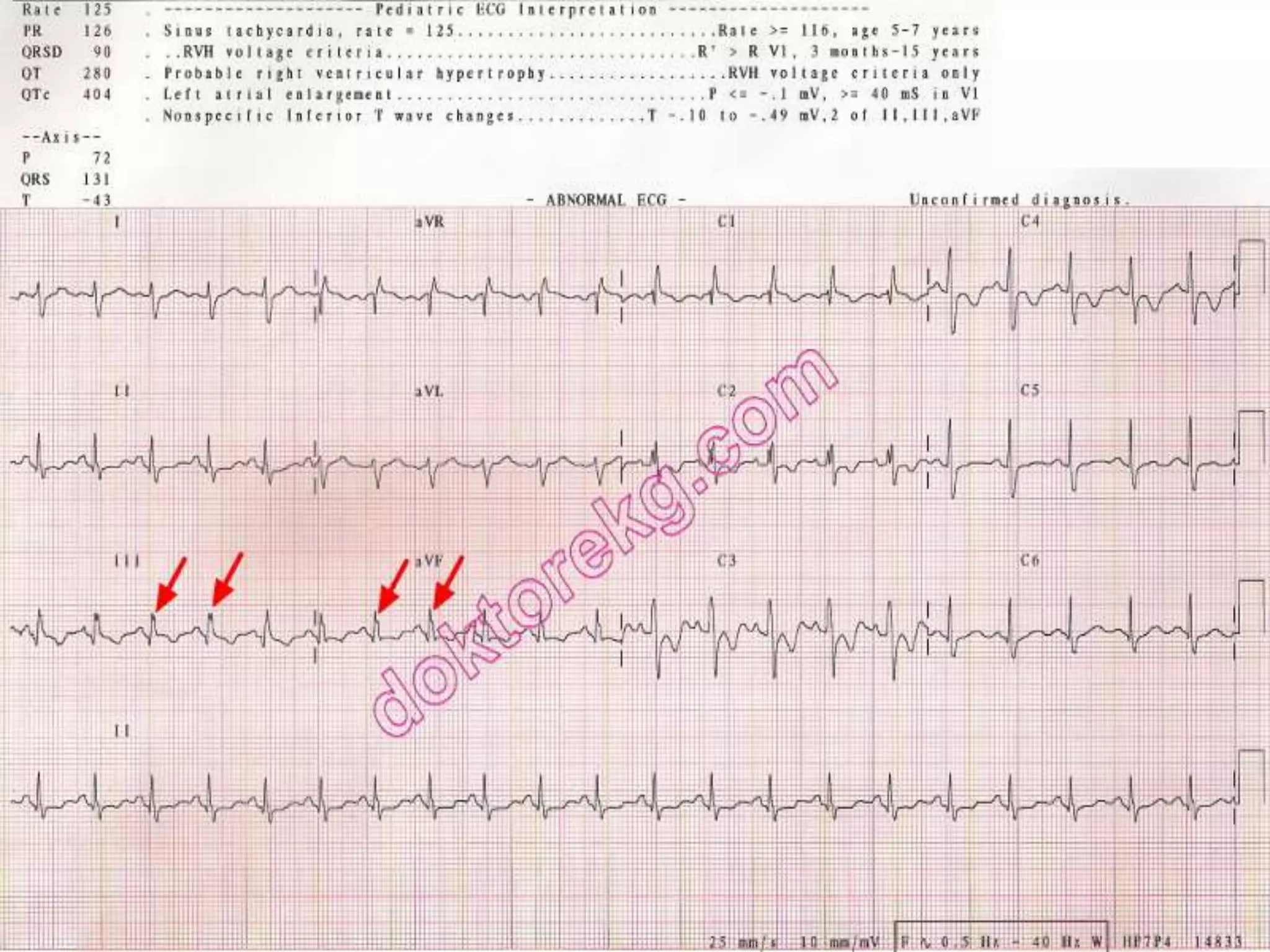 Neonatal heart diseases | PPTX
