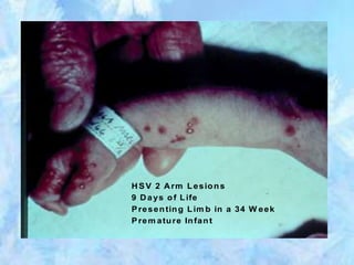 Neonatal herpes simplex infections | PPTX