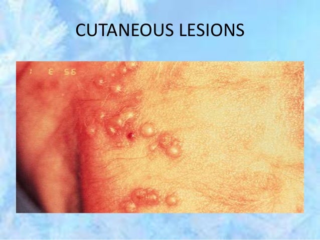 Neonatal herpes simplex infections