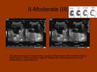 Neonatal hydronephrosis | PPT