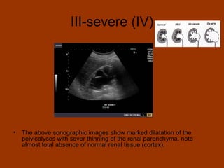 Neonatal hydronephrosis | PPT