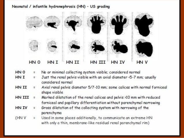 Neonatal hydronephrosis