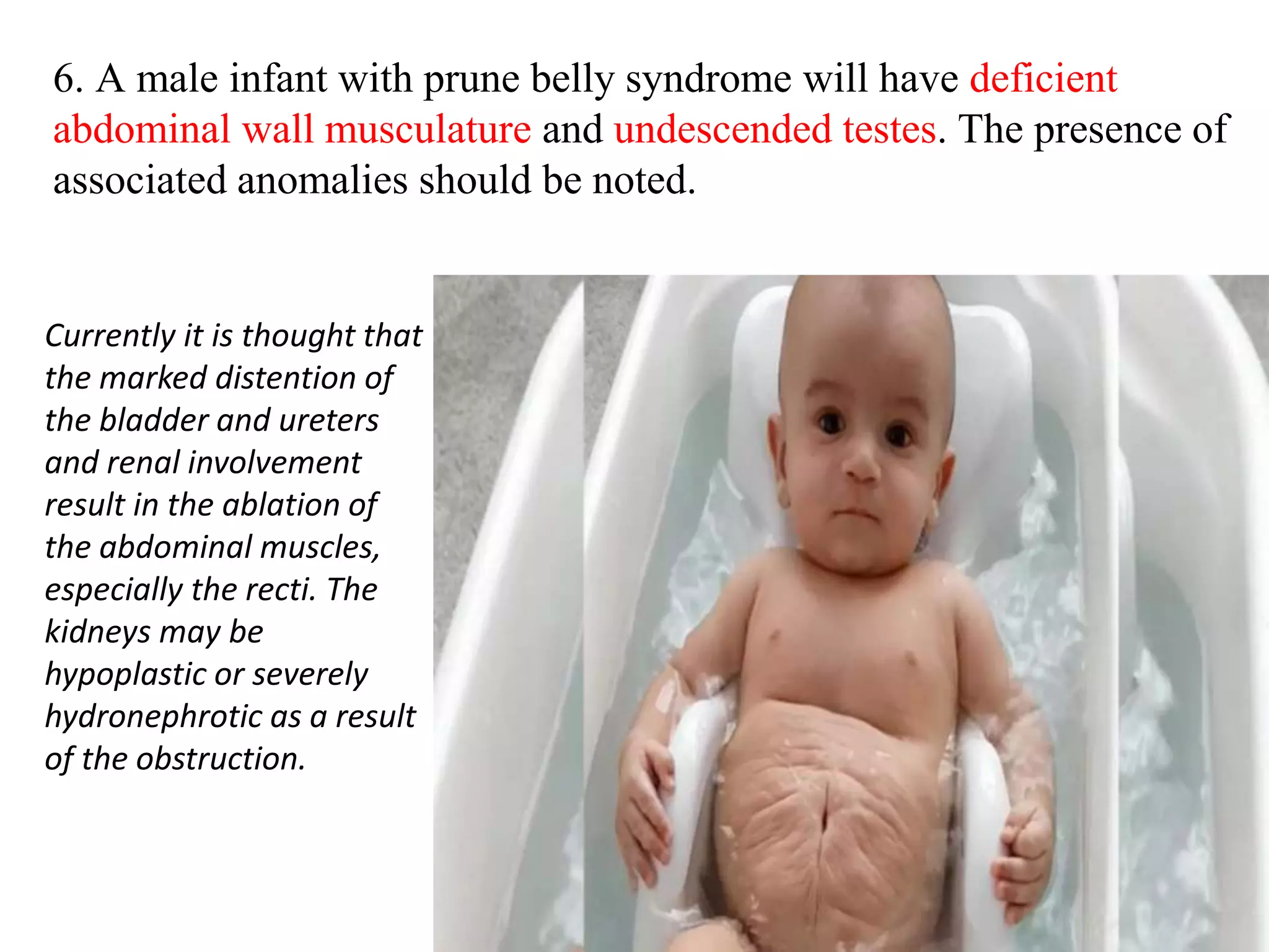 Neonatal hydronephrosis | PPTX