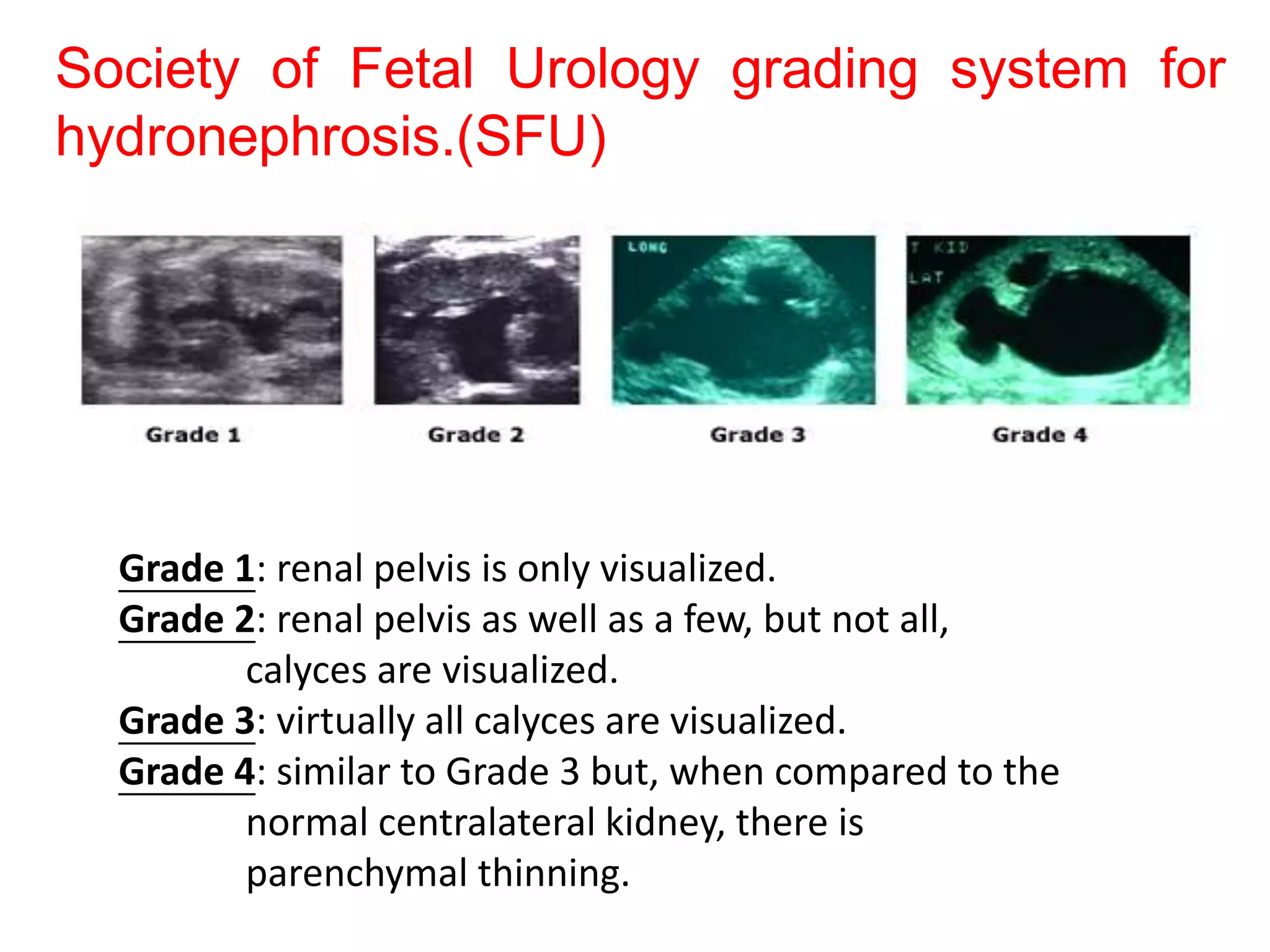 Neonatal hydronephrosis | PPTX
