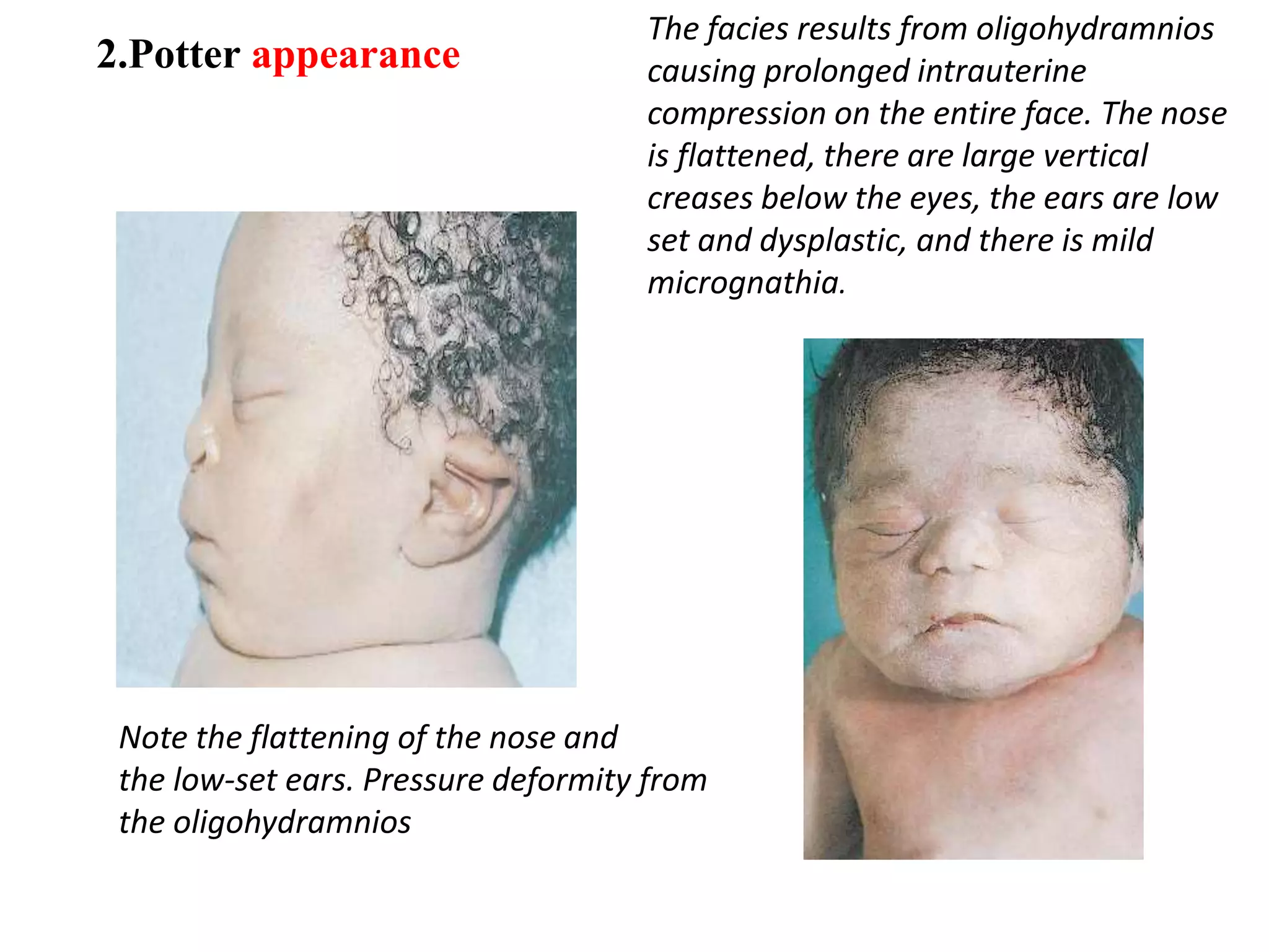 Neonatal hydronephrosis | PPTX