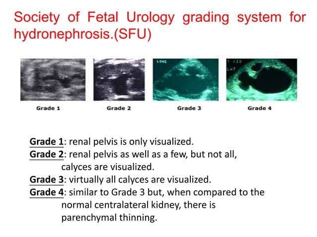 Neonatal hydronephrosis | PPTX
