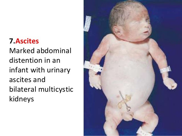 Neonatal hydronephrosis