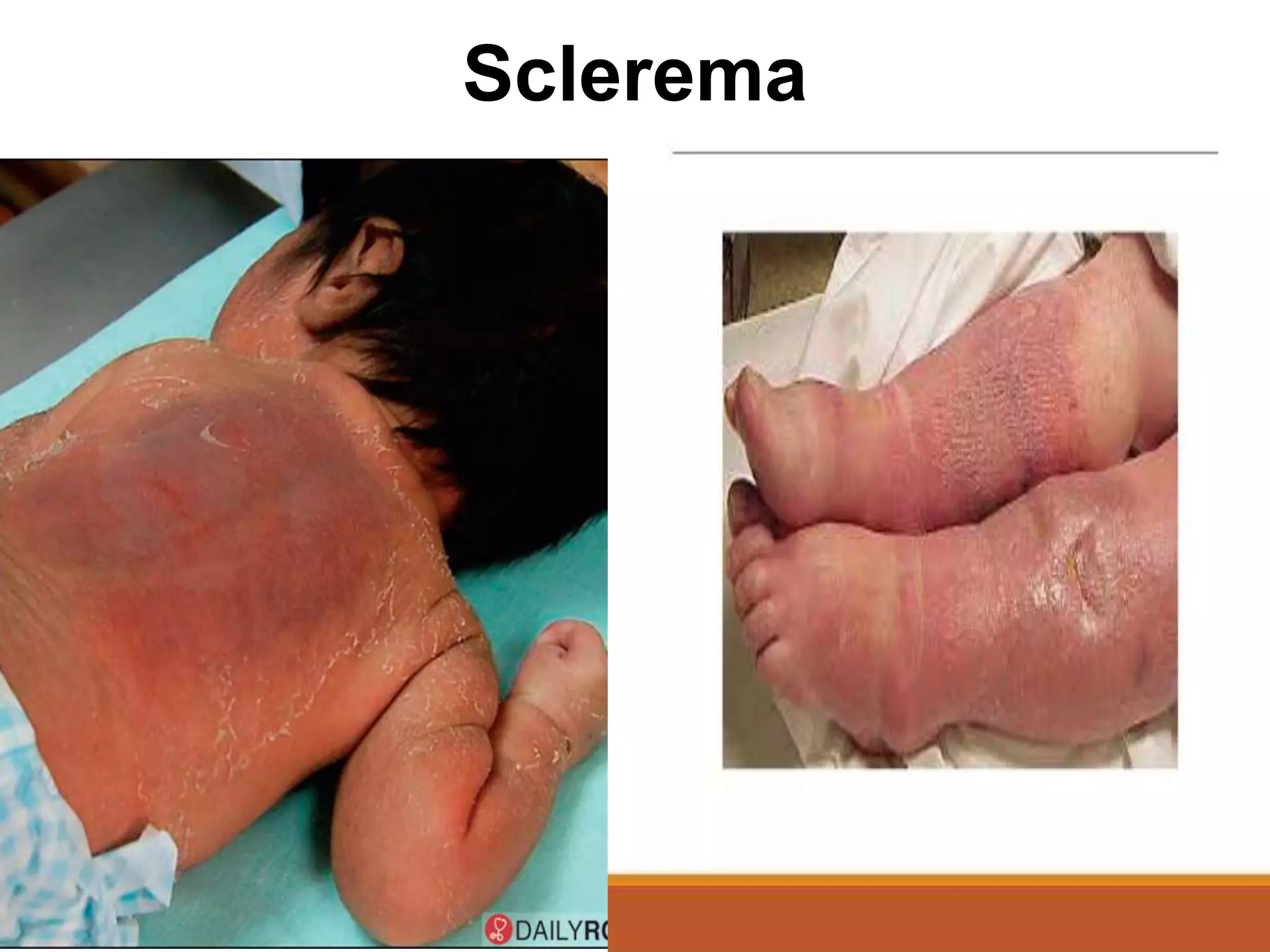 Neonatal hypothermia | PPTX