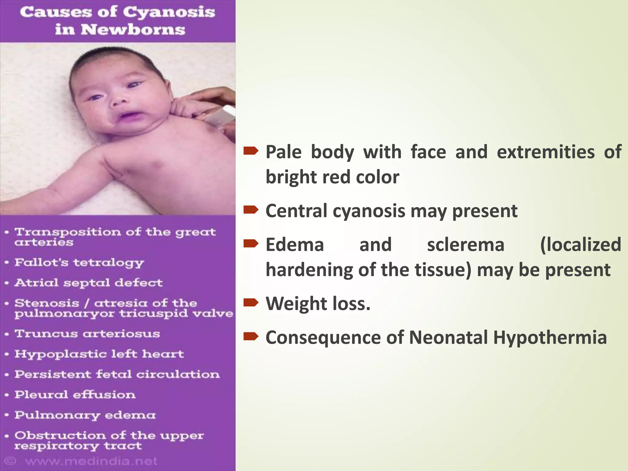 Neonatal hypothermia | PPTX