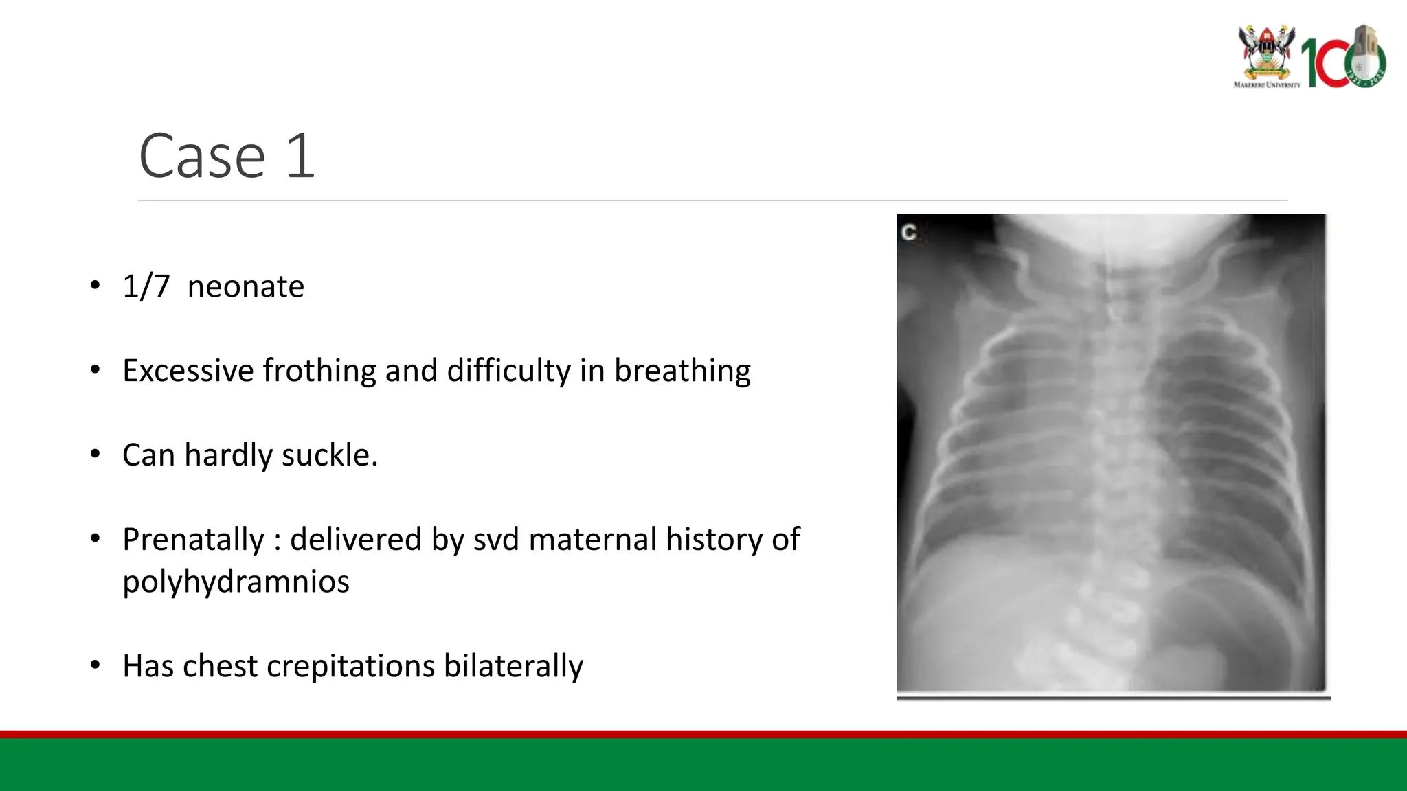 neonatal Intestinal obstruction; etiology, diagnosis and management.pptx