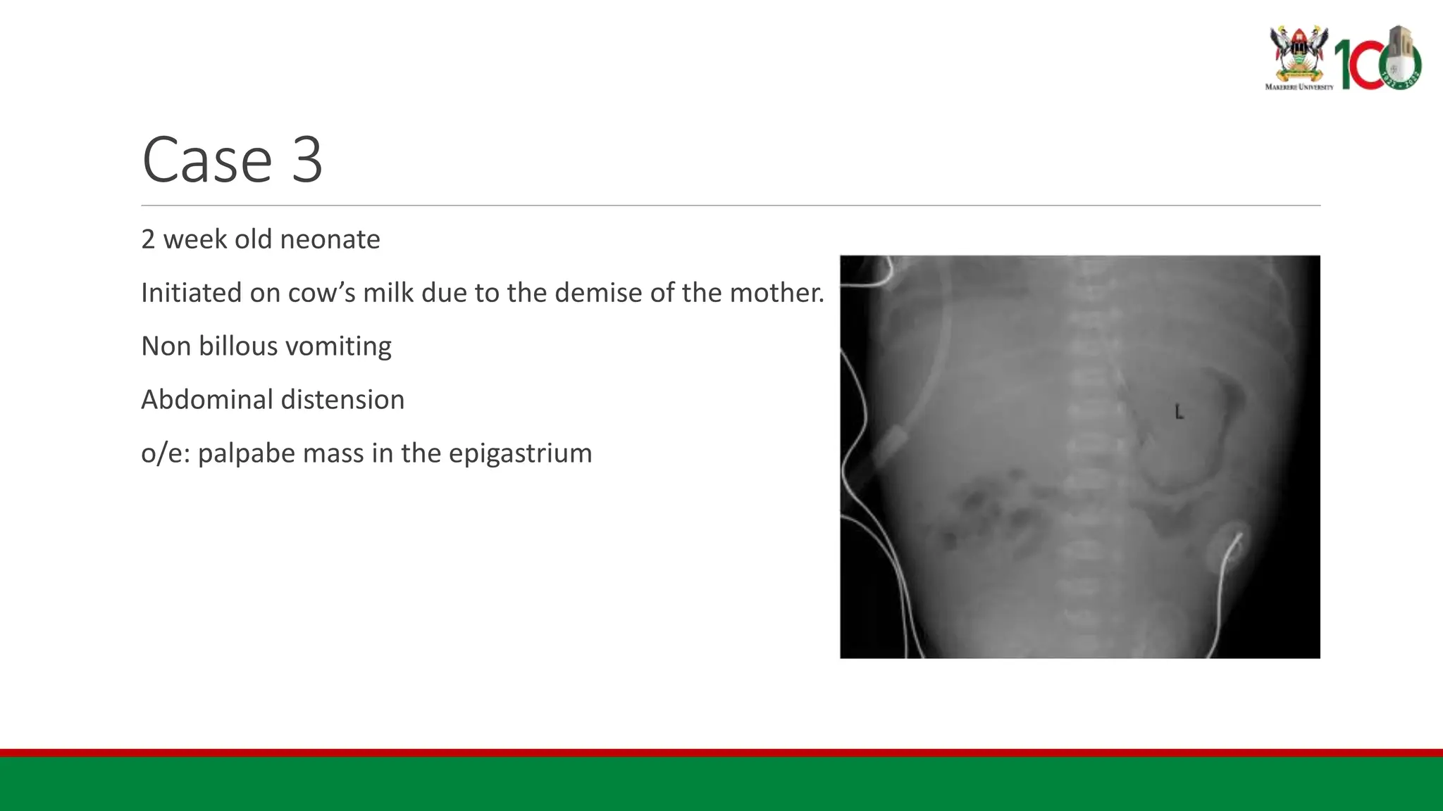 neonatal Intestinal obstruction; etiology, diagnosis and management.pptx