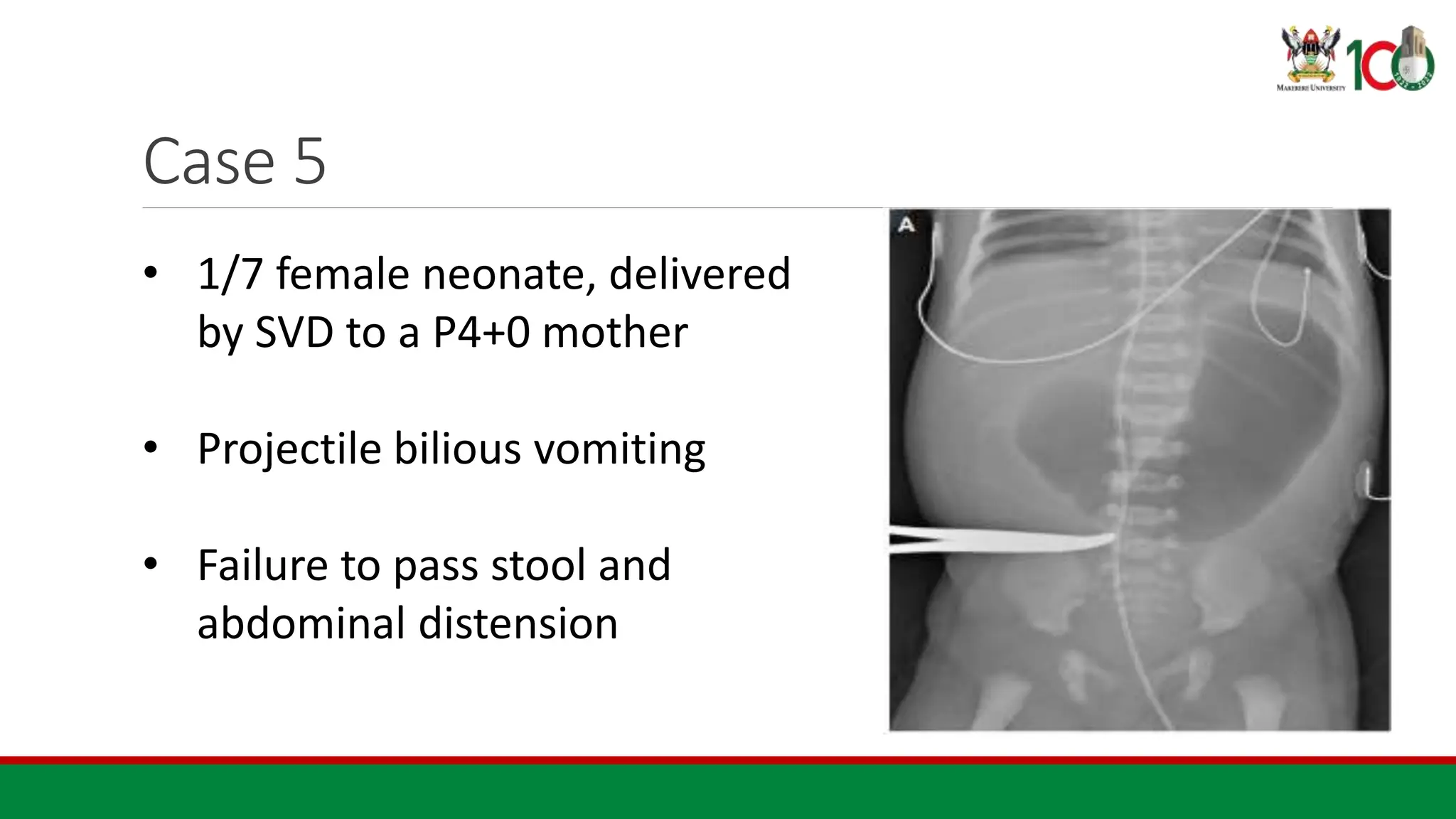 neonatal Intestinal obstruction; etiology, diagnosis and management.pptx