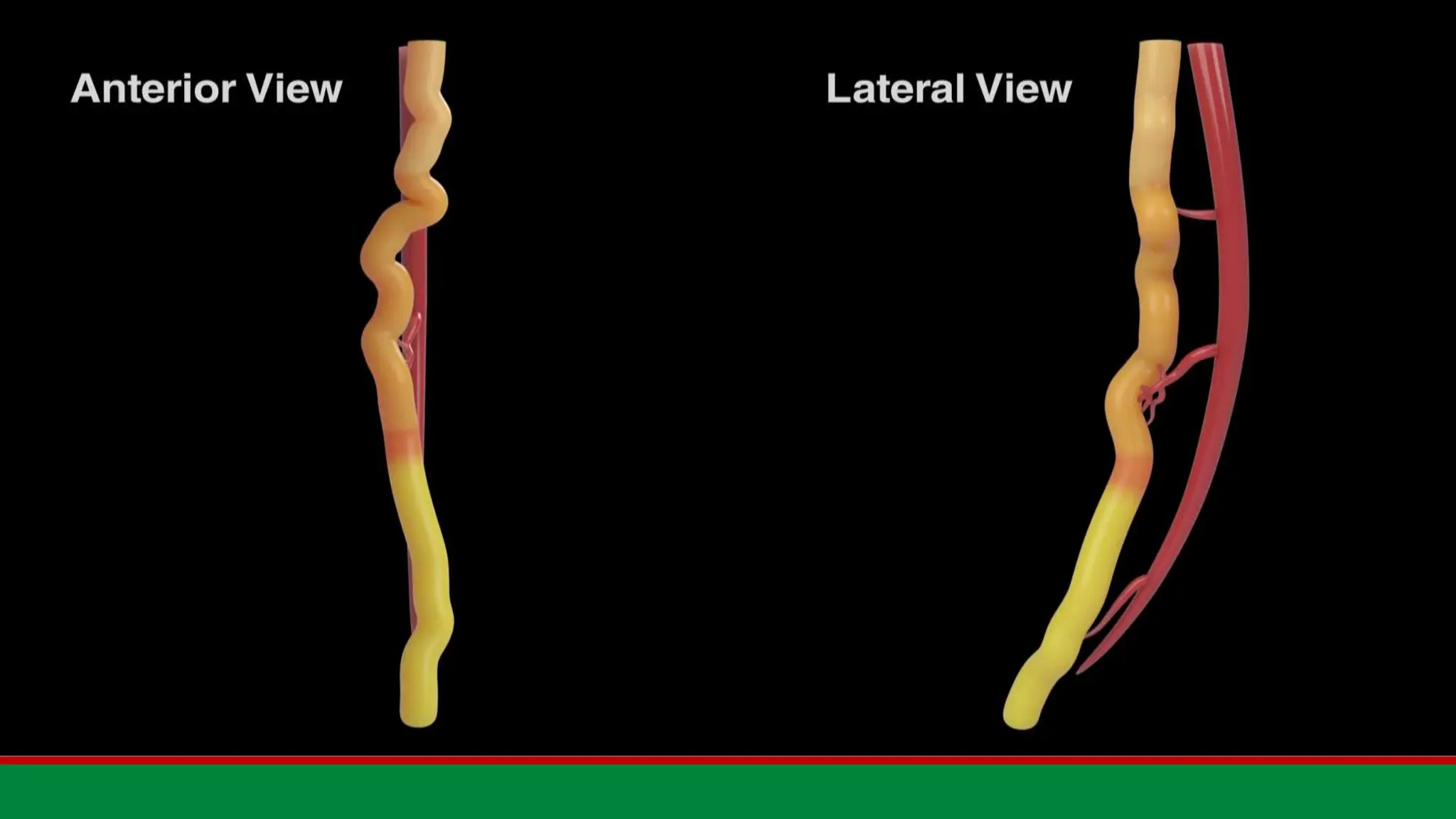 neonatal Intestinal obstruction; etiology, diagnosis and management.pptx