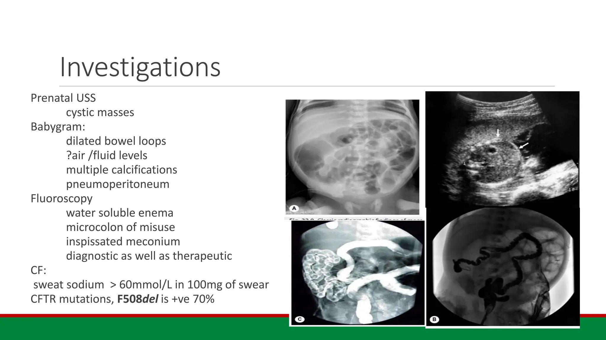 neonatal Intestinal obstruction; etiology, diagnosis and management.pptx